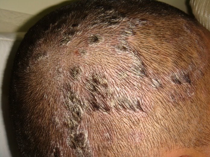 Skin Care Tips From Dermatologist Itchy Scalp Remedies