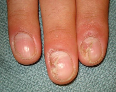 Fair Queens: Nail Fold Inflammation (Paronychia)