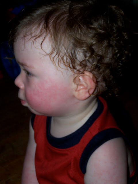 The Perils of a Working Mom: Fifth Disease