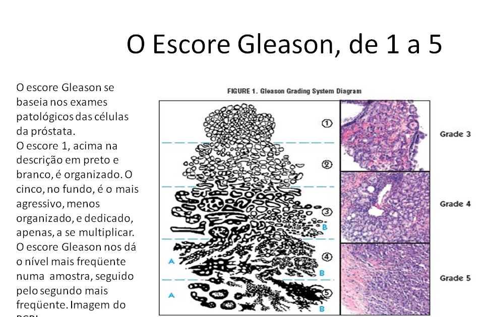 Câncer de próstata - notícias e pacientes: O Escore Gleason - foto e ...