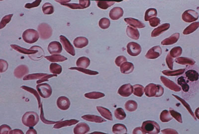 Anemia Falciforme: Medicamentacion Farmacologica Contra la Anemia ...