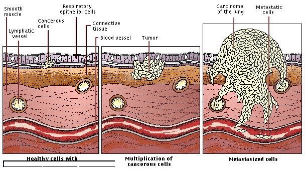 Health Problem & Solutions: Development of Cancer