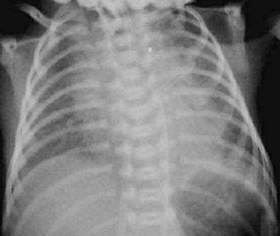 Respiratory distress syndrome (hyaline membrane disease) | Media of ...