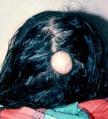 gros boutons sur l'arrière du crane