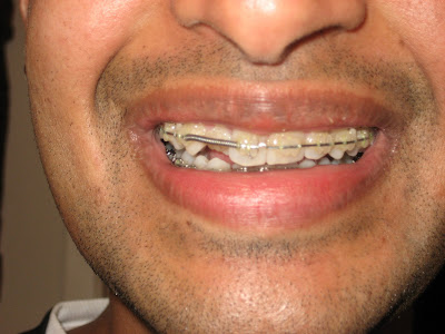 Sid in Braces