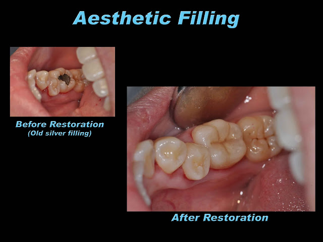 Prestige Dental Care: Aesthetic Filling