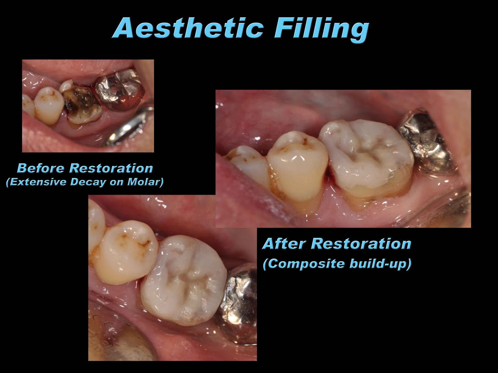 Prestige Dental Care: Aesthetic Filling