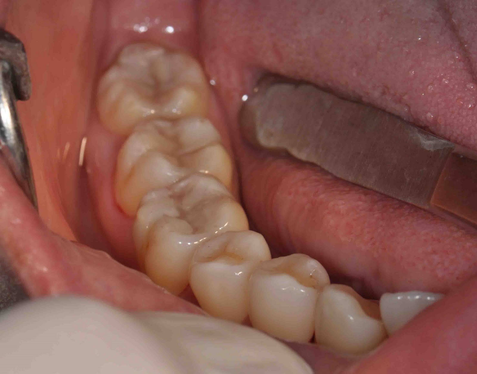 Treatment Options: Dental Aesthetic with White Filling II (On Back Teeth)