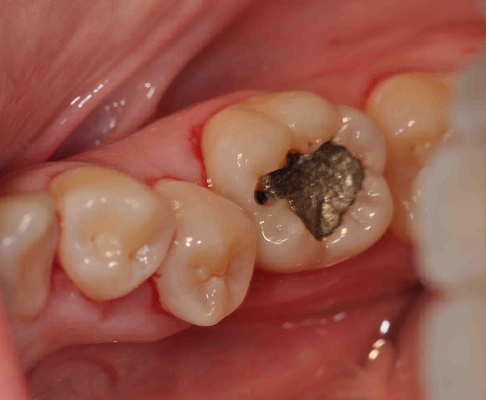 Treatment Options: Dental Aesthetic with White Filling II (On Back Teeth)