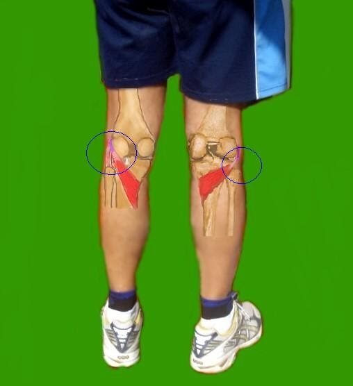 El blog de Francisco Gilo: Tendinitis Poplítea