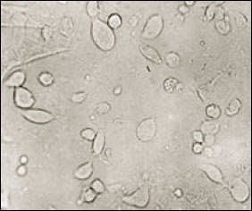 Annals of Nurse-Midwifery: Strawberry Cervix