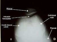 proyecciones radiologicas: "MÈTODO DE SETTEGAST"