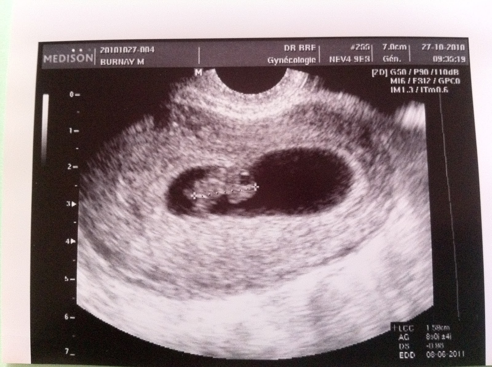 Un petit bout de nous...: Echographie à 6 semaines de grossesse +3 ...