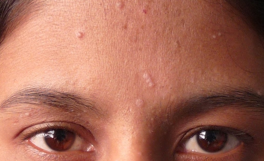 Doctor's life: verruca plana or flat wart