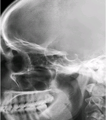 Red Medica: Lateral De Silla Turca