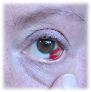 Ineke's Skrep Wep: Gesprongen ader!