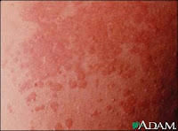 Pharmacy and Medicine: Tinea Versicolor-The Fungal Infection