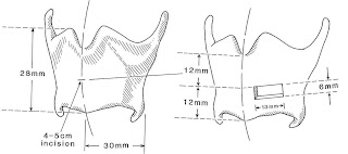 ENT for medical students: LARYNX - Laryngeal Paralysis