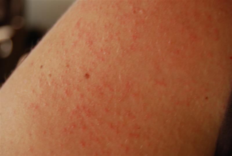 Life in Liberia: Guess My Skin Disease!