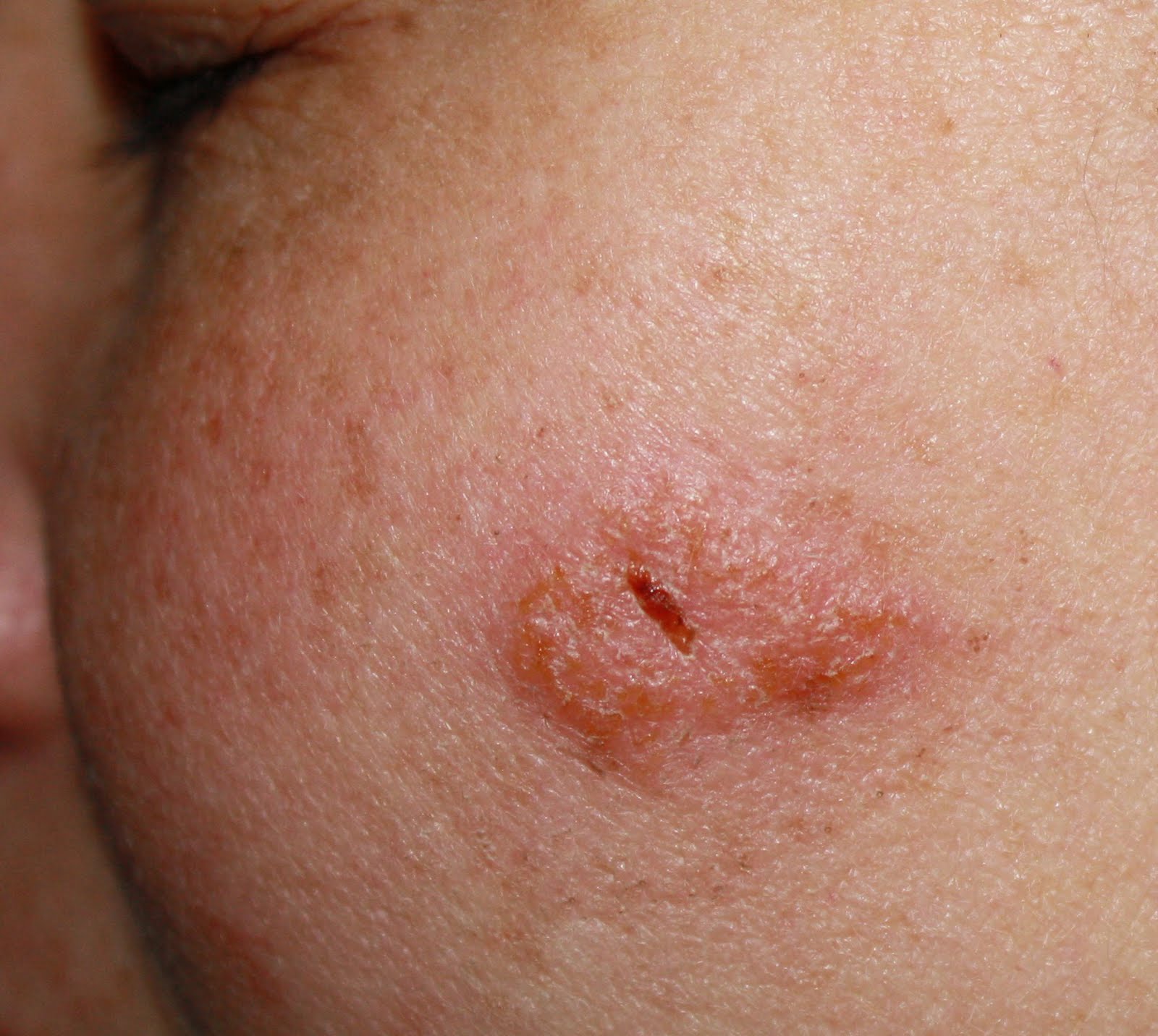 List 94+ Pictures Pictures Of Ringworms On Face Latest