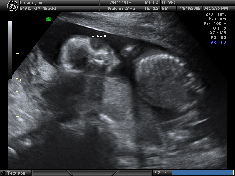 Lola Nicole Hirsch: 19 Weeks Ultrasound