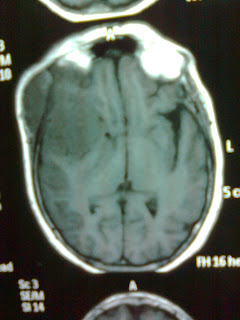 ummara shares: SPHENOID WING MENINGIOMA WITH EXTENSION INTO THE RIGHT ORBIT