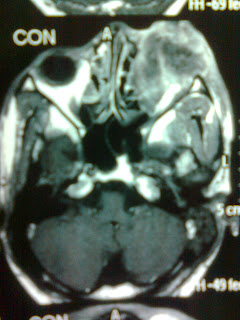 ummara shares: CA SUPRASTRUCTURE OF LEFT MAXILLARY ANTRUM