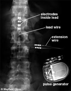 Cheri Quite Contrary: Spinal Cord Stimulator Updates and Info