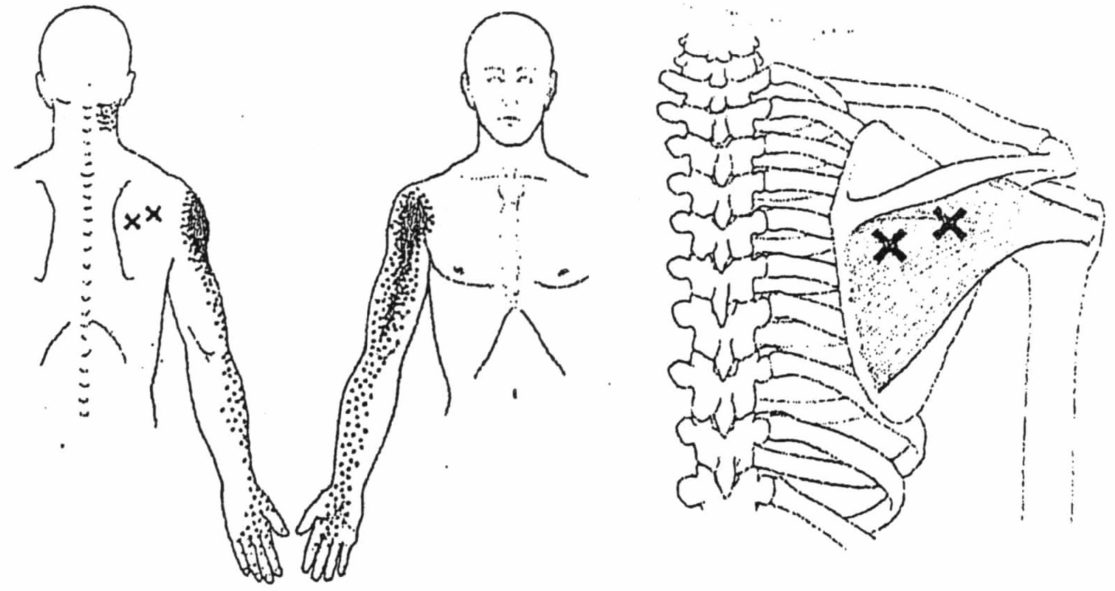 Puntos gatillos o de dolor: infraespinoso