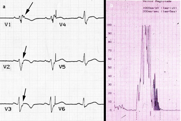 Pedi cardiology: EKG: Epsilon Wave