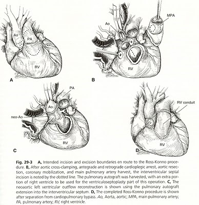 Pedi cardiology: Surgery: Konno, Ross-Konno