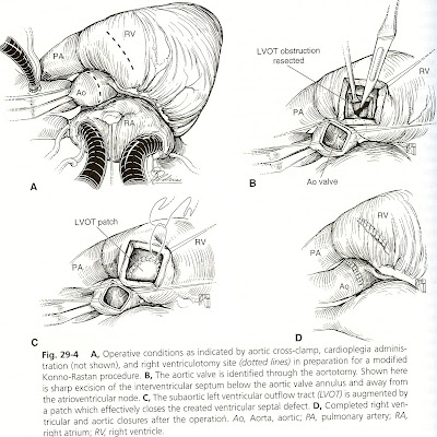 Pedi cardiology: Surgery: Konno, Ross-Konno