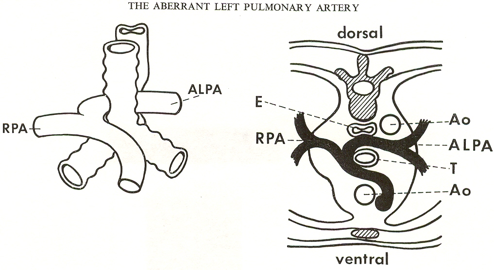 Pedi cardiology: Anatomy: Aberrant RSCA, Pulmonary Sling, Barium Swallow
