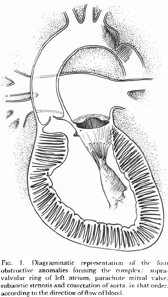Pedi cardiology: Anatomy: Shone's Complex