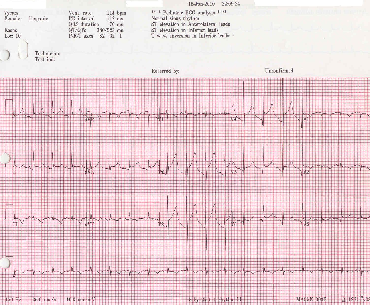 Pedi cardiology: ICU / EKG: Postop ST segment elevation