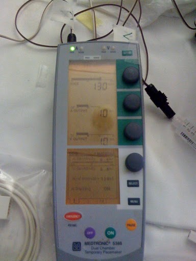 Pedi cardiology: ICU: Temporary Pacemaker