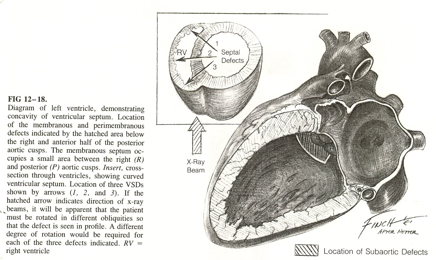 Pedi cardiology: Cath: Imaging VSD