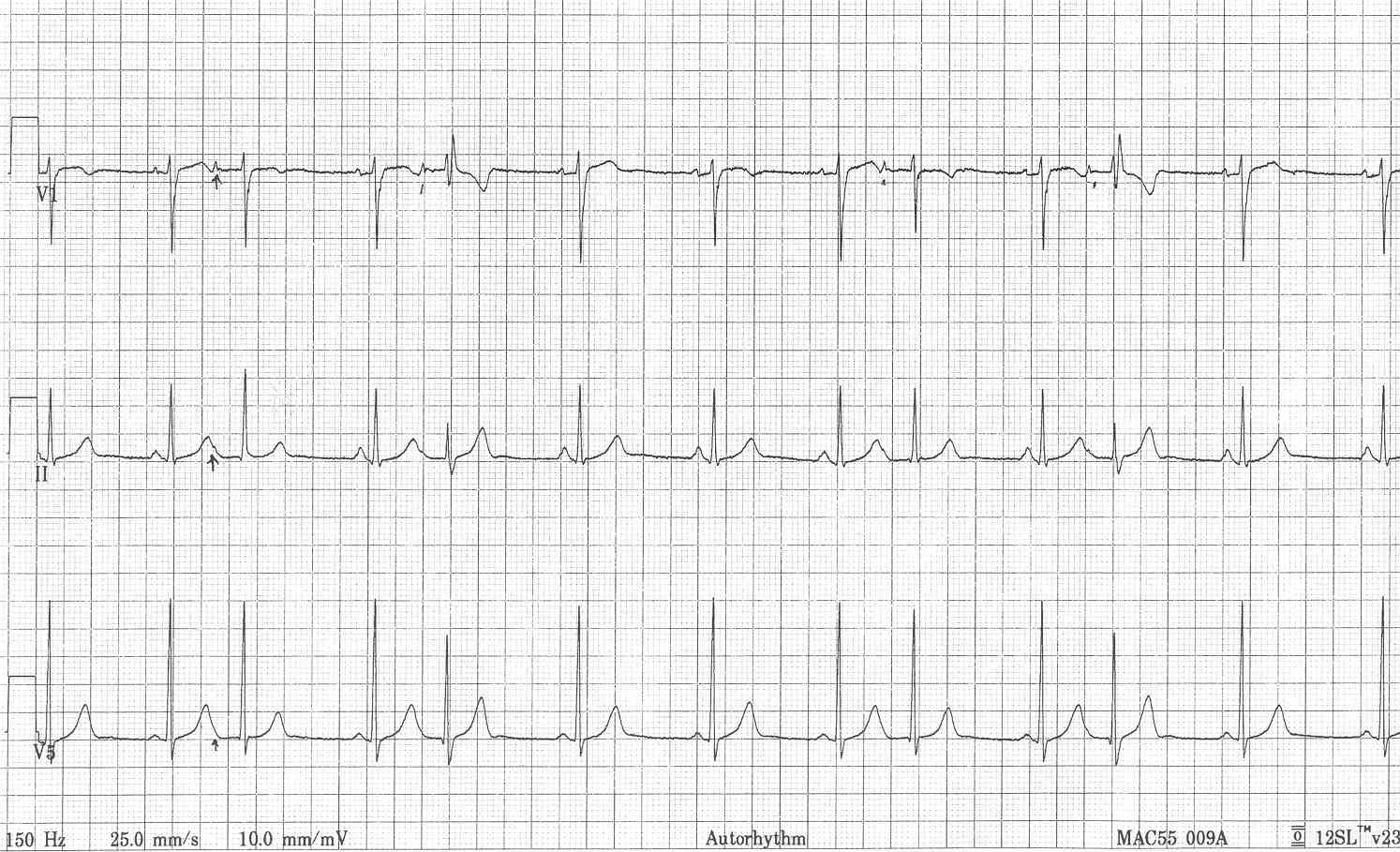 Pedi cardiology: Atrial Ectopy
