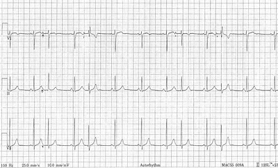 Pedi cardiology: Atrial Ectopy