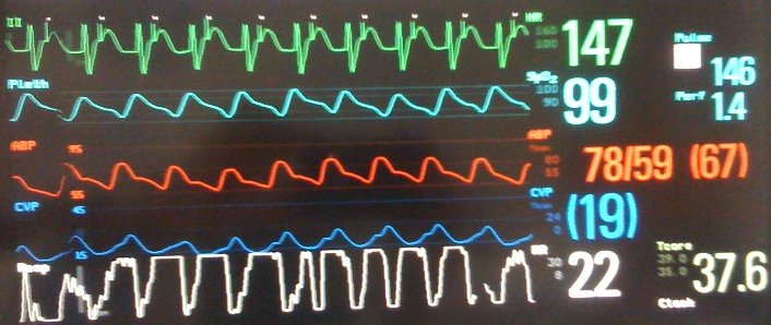 Pedi cardiology: ICU: Monitor, A-pace, AV-pace, CVP trace