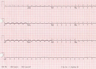 Pedi cardiology: EKG: Low Voltage Complexes & Lead Misplacement