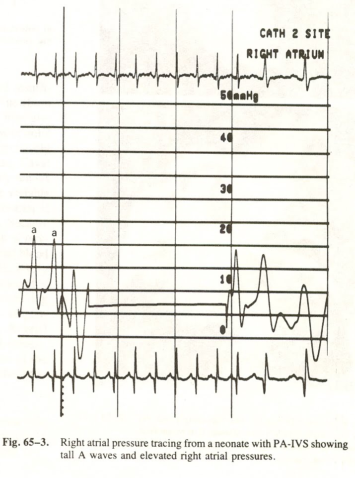 Pedi cardiology: Cath Lab: Pressure Trace, Giant a wave in RA