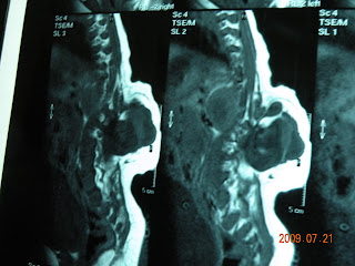Neurosurgery Residency: Spinal Dysraphism