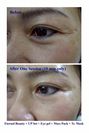 Elysyle Eternal Beauty (EB) Machine