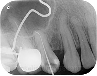 Odontología: Rotura lima y apiceptomía