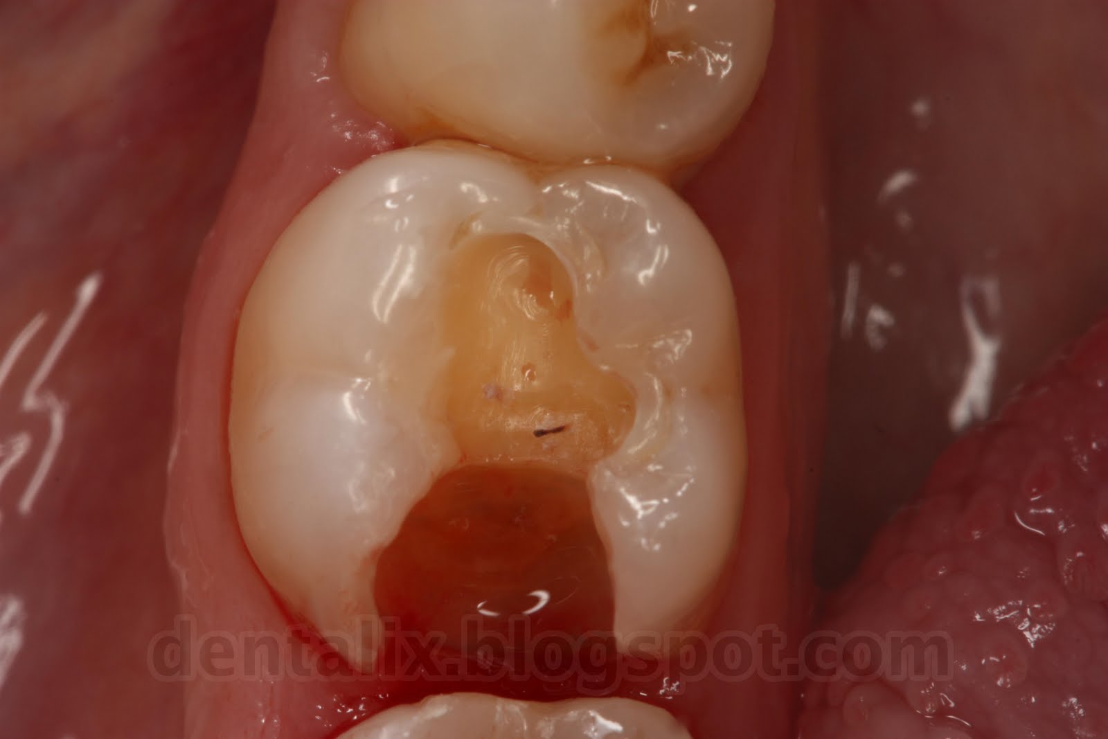 Odontología: Caries secundaria profunda