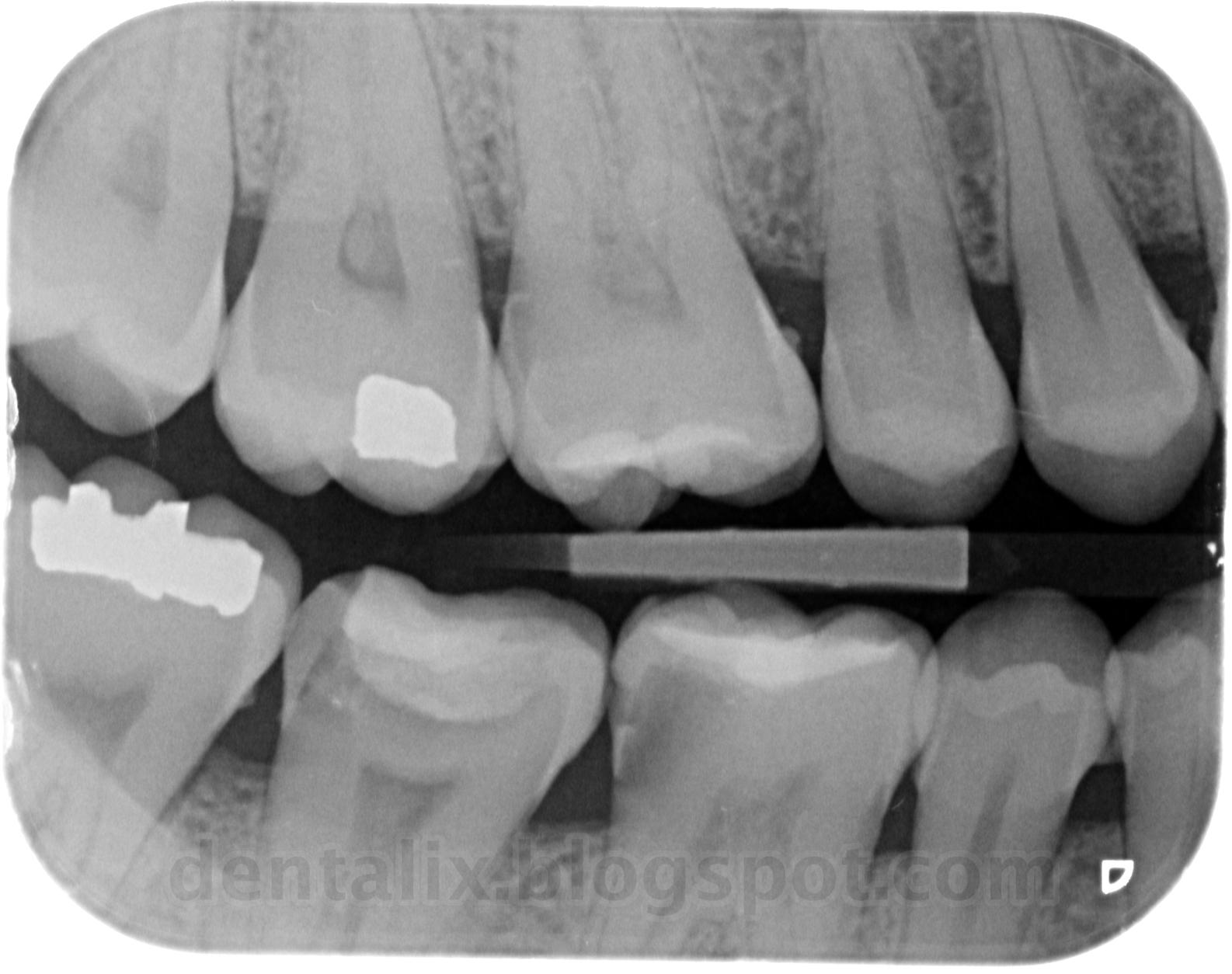 Odontología: Caries secundaria profunda