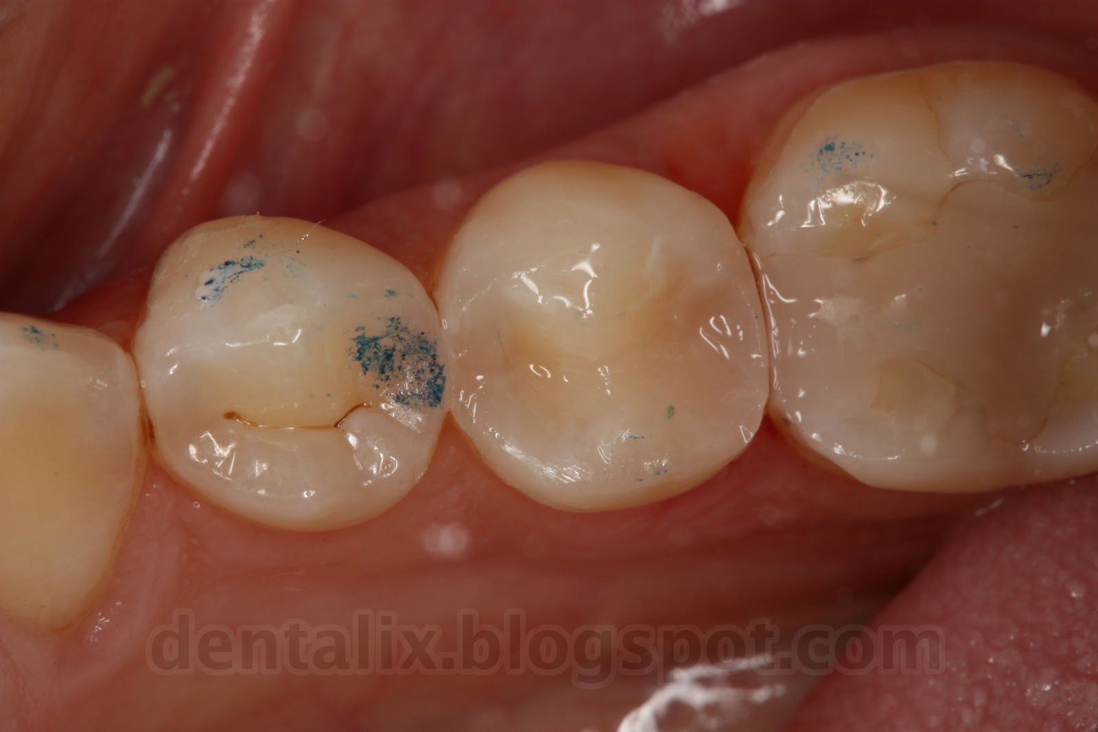 Odontología: El aviso de la amalgama