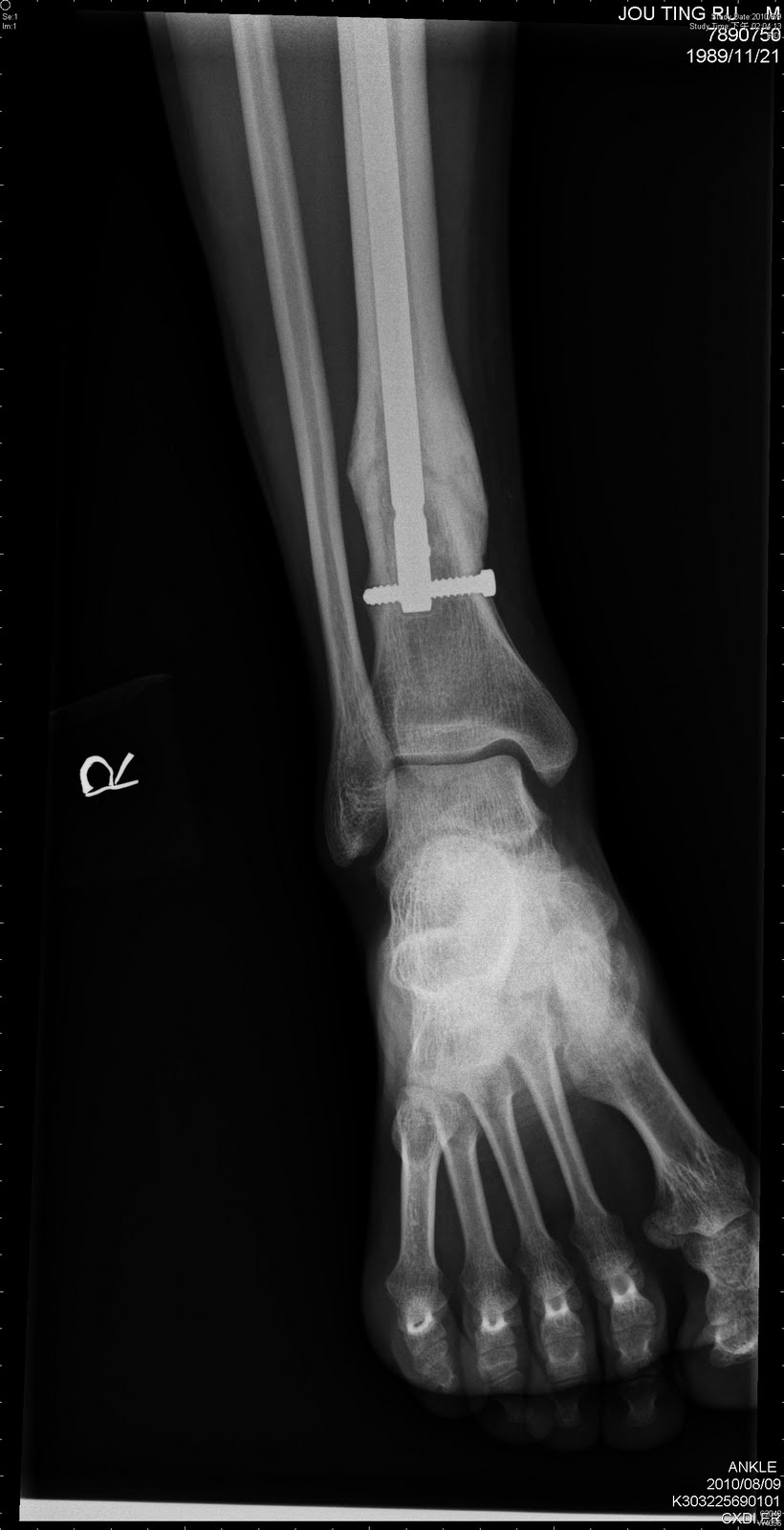 Big Bad: Neighbor tibia low shaft fracture with good callus formation