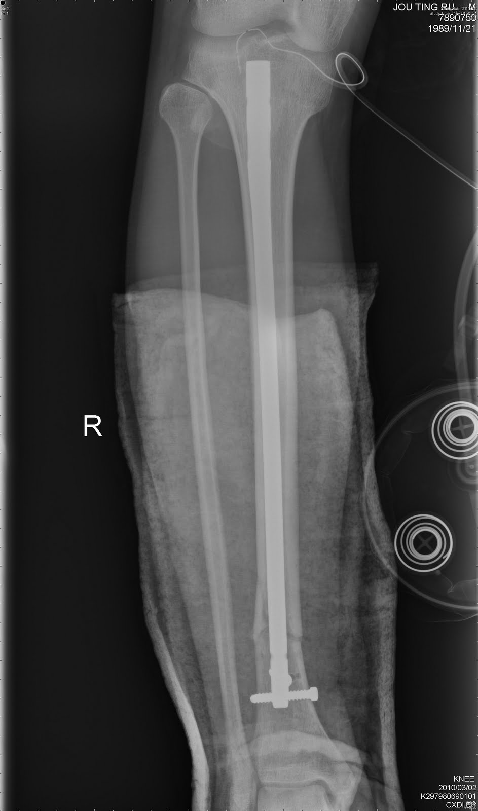 Big Bad: Neighbor tibia low shaft fracture with good callus formation